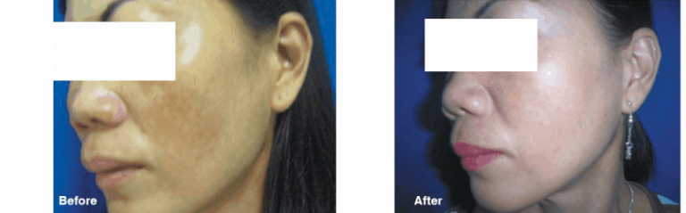 Pynocare Philippines | Clinically Proven Oral Medicine to Reduce Melasma