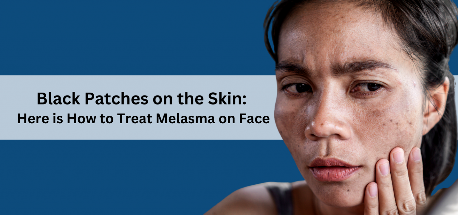 Black Patches on Skin: Here is How to Treat Melasma on Face