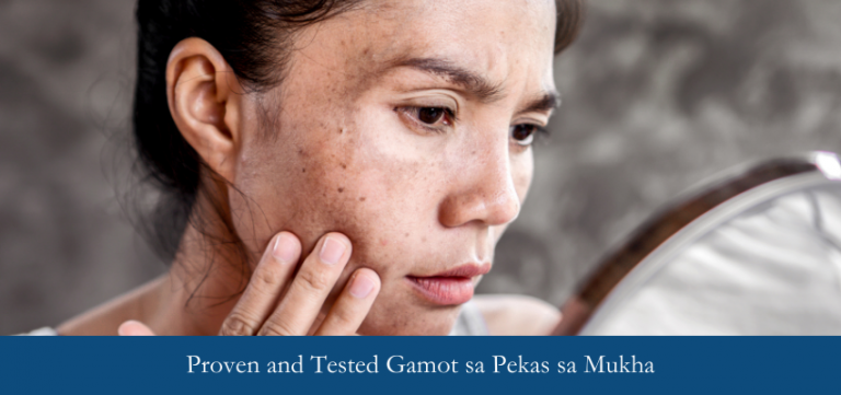 Proven and Tested Gamot sa Pekas sa Mukha | Pynocare.ph